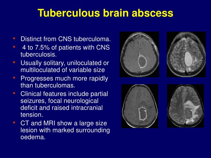 PPT - CNS Tuberculosis PowerPoint Presentation - ID:6336519