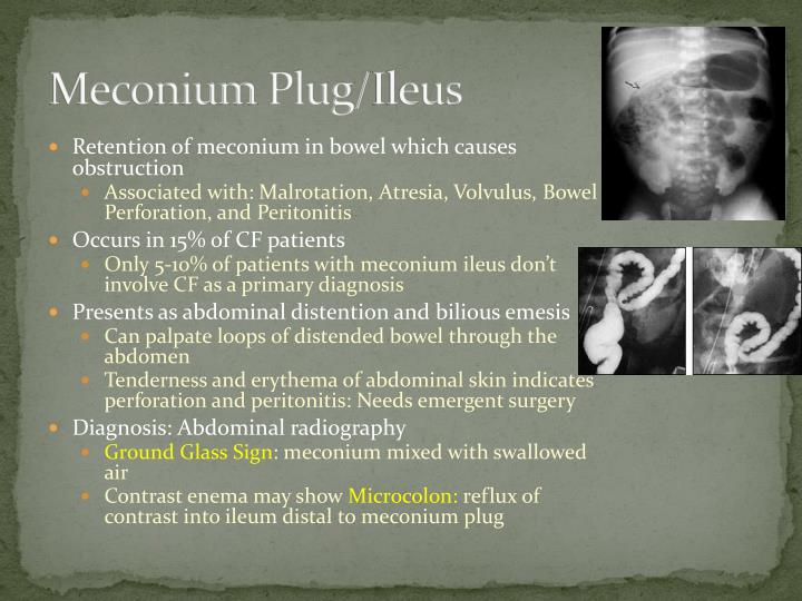 PPT - Neonatal Bilious Emesis PowerPoint Presentation - ID:6338342