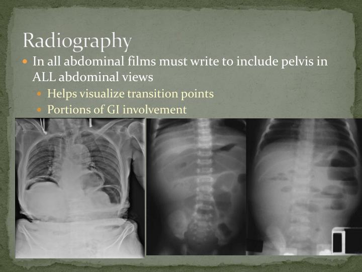 PPT - Neonatal Bilious Emesis PowerPoint Presentation - ID:6338342