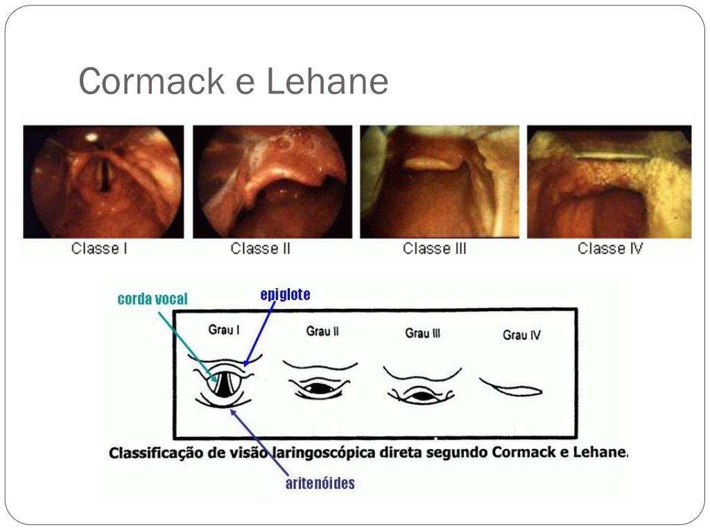 PPT - INTUBAÇÃO ENDOTRAQUEAL, VIA AÉREA DIFÍCIL, CRICOTIREOIDOSTOMIA E ...