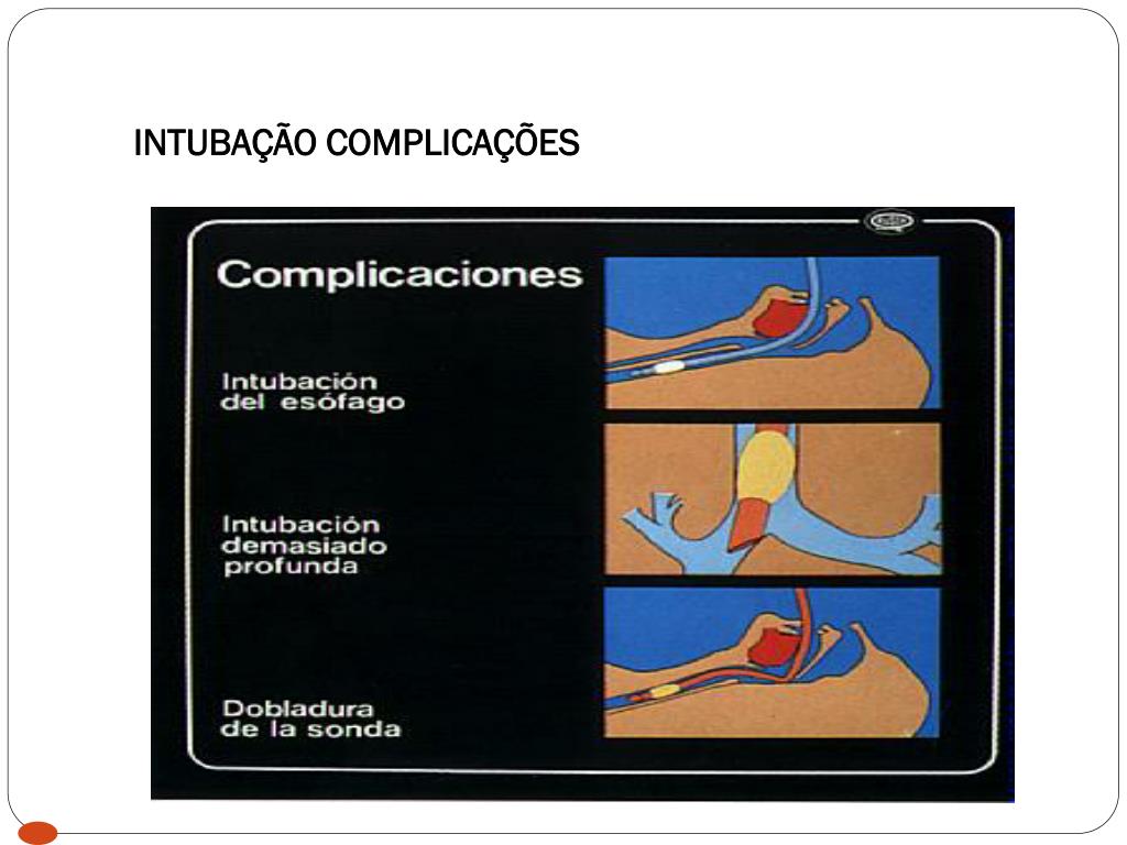 PPT - INTUBAÇÃO ENDOTRAQUEAL, VIA AÉREA DIFÍCIL, CRICOTIREOIDOSTOMIA E ...