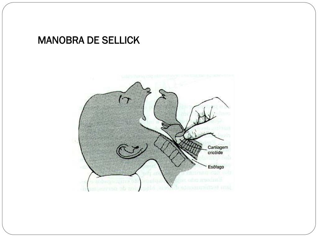 PPT - INTUBAÇÃO ENDOTRAQUEAL, VIA AÉREA DIFÍCIL, CRICOTIREOIDOSTOMIA E ...