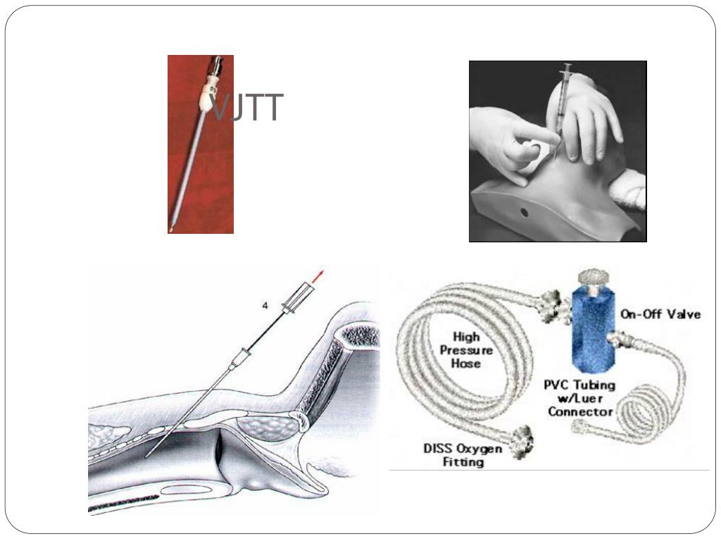 PPT - INTUBAÇÃO ENDOTRAQUEAL, VIA AÉREA DIFÍCIL, CRICOTIREOIDOSTOMIA E ...
