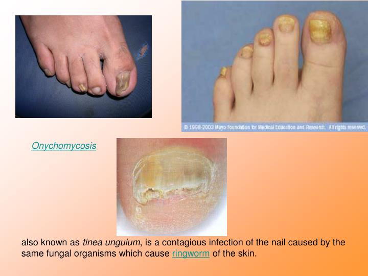 PPT - The most commonly reported nail conditions, seen by podiatrists ...