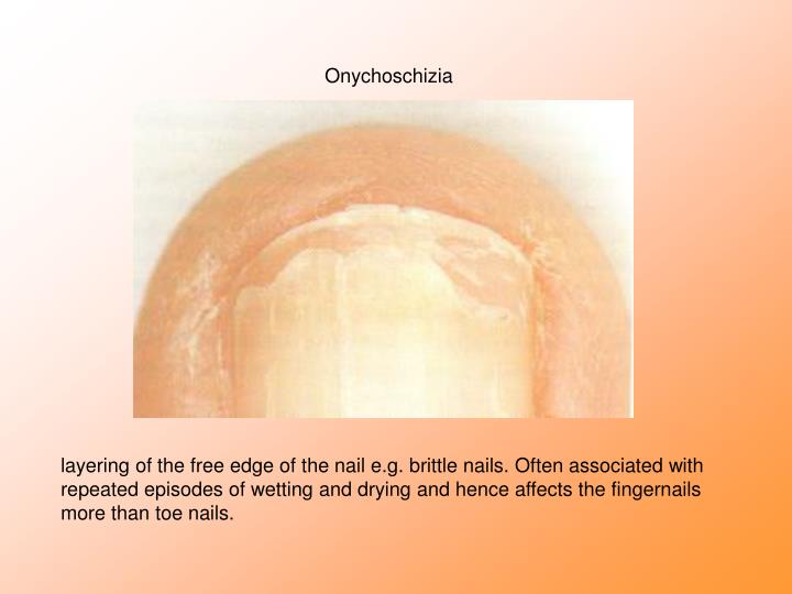 PPT - The most commonly reported nail conditions, seen by podiatrists ...