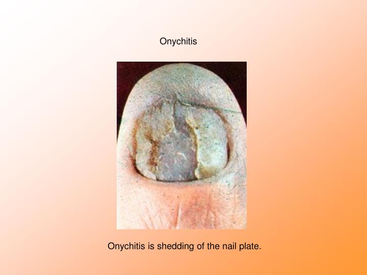 PPT - The most commonly reported nail conditions, seen by podiatrists ...