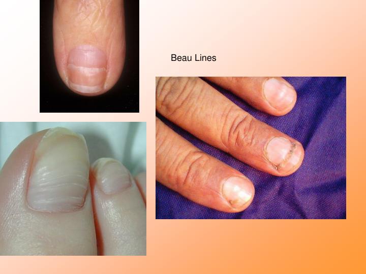 PPT - The most commonly reported nail conditions, seen by podiatrists ...
