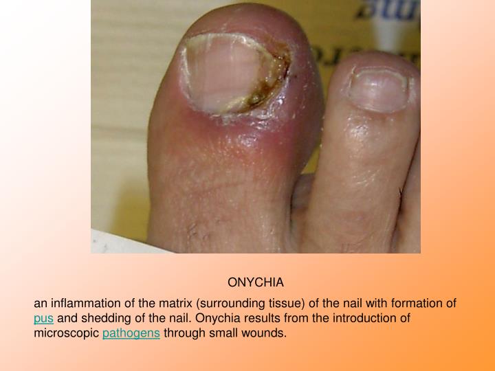 PPT - The most commonly reported nail conditions, seen by podiatrists ...