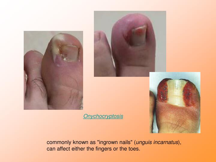 PPT - The most commonly reported nail conditions, seen by podiatrists ...