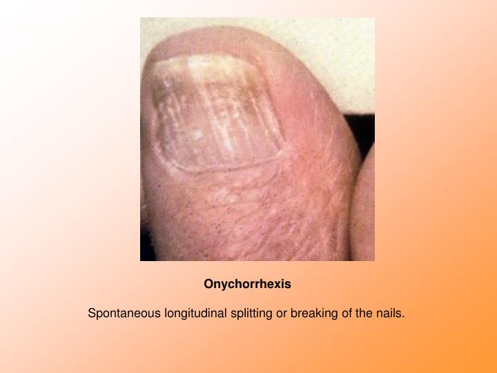 PPT - The most commonly reported nail conditions, seen by podiatrists ...