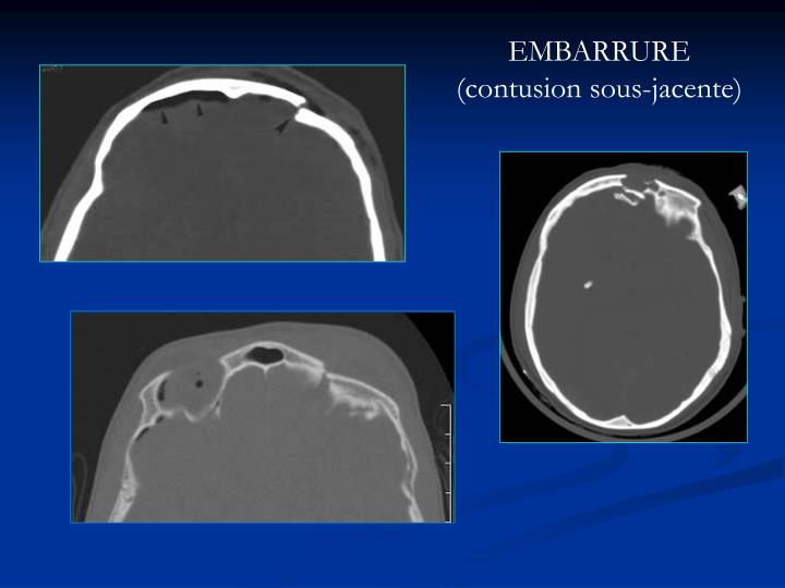 PPT - TRAUMATISMES CRÂNIO-ENCEPHALIQUES PowerPoint Presentation - ID ...
