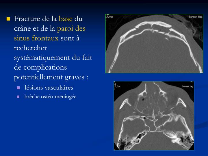 PPT - TRAUMATISMES CRÂNIO-ENCEPHALIQUES PowerPoint Presentation - ID ...