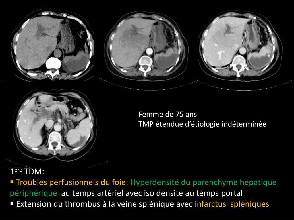PPT - IMAGERIE DES THROMBOSES DU SYSTEME VEINEUX PORTE PowerPoint ...