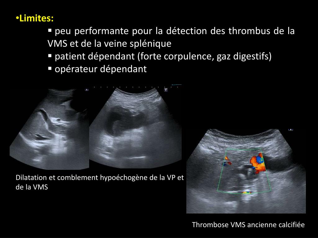 PPT - IMAGERIE DES THROMBOSES DU SYSTEME VEINEUX PORTE PowerPoint ...