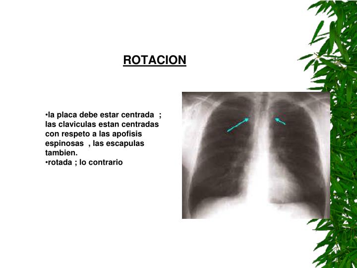 PPT - RADIOGRAFIA DE TORAX PowerPoint Presentation - ID:6360862