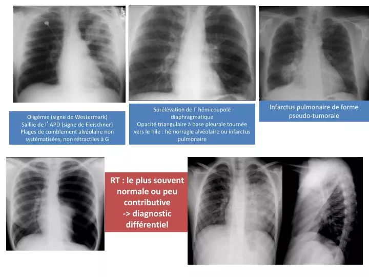 PPT - Surélévation de l ’ hémicoupole diaphragmatique PowerPoint ...