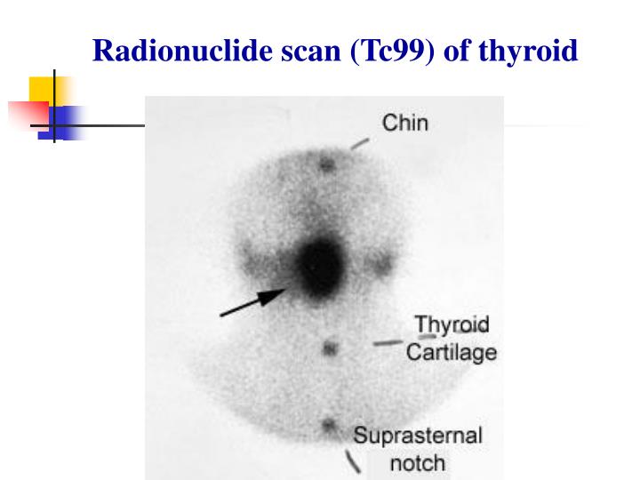 PPT - Congenital Hypothyroidism PowerPoint Presentation - ID:6361450