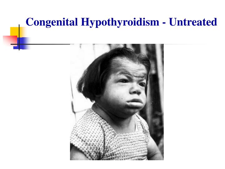 PPT - Congenital Hypothyroidism PowerPoint Presentation - ID:6361450