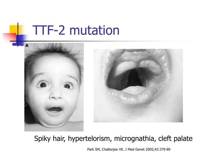 PPT - Congenital Hypothyroidism PowerPoint Presentation - ID:6361450
