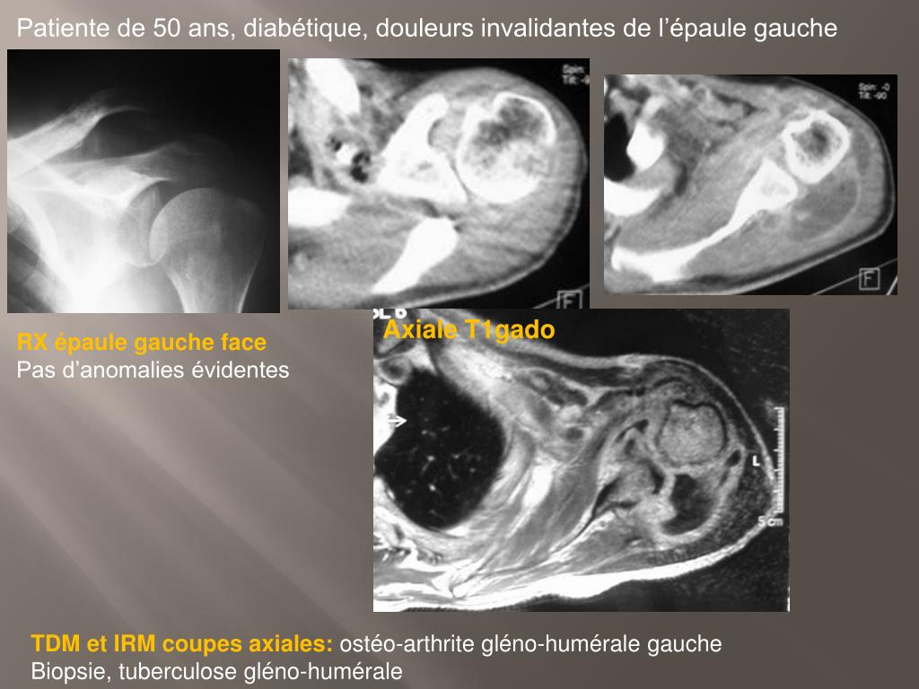 PPT - TUBERCULOSE OSTEO-ARTICULAIRE EXTRA RACHIDIENNE: aspect en ...