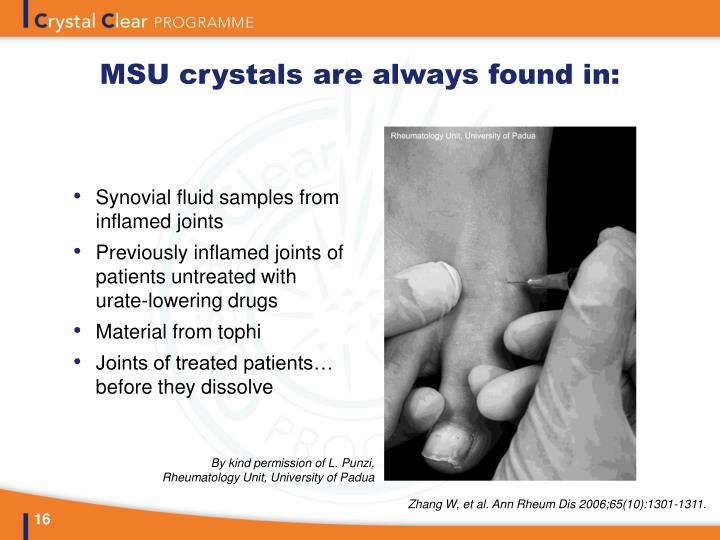 PPT - Diagnosis of gout PowerPoint Presentation - ID:6371400