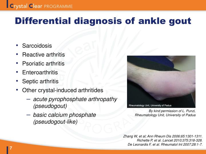 PPT - Diagnosis of gout PowerPoint Presentation - ID:6371400