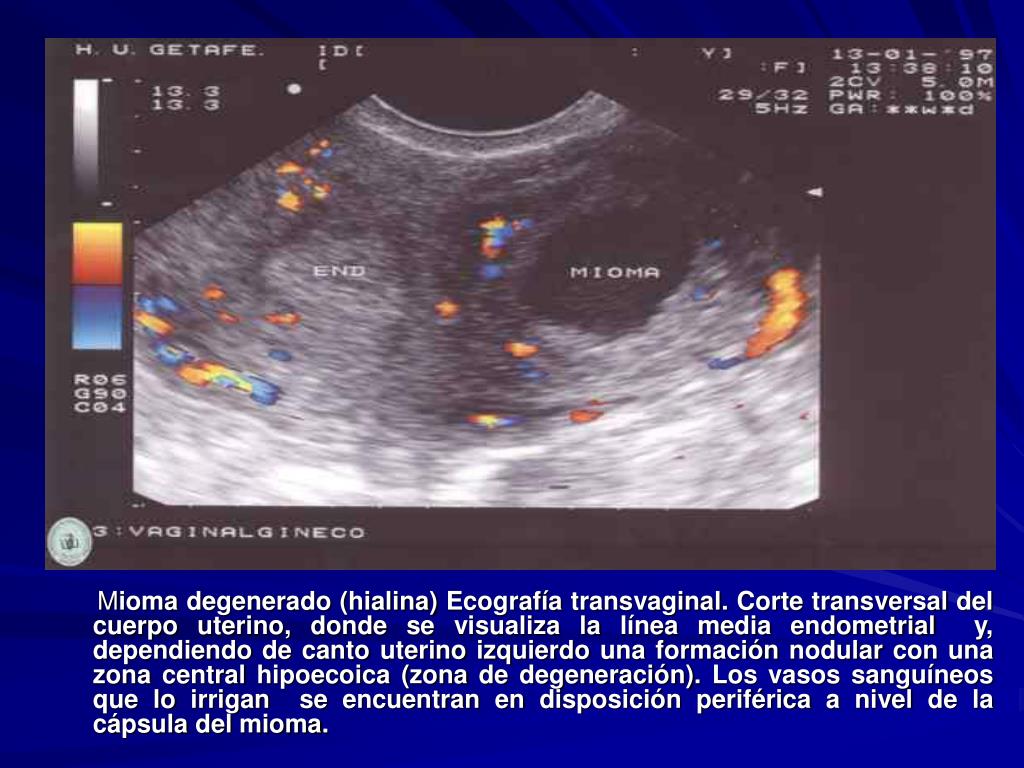 PPT - DIPLOMADO DE ULTRASONOGRAFIA EN OBSTETRICIA Mioma Uterino y ...