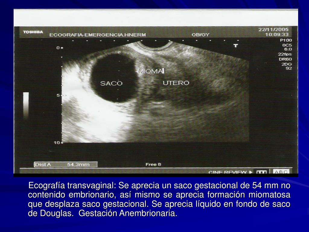 PPT - DIPLOMADO DE ULTRASONOGRAFIA EN OBSTETRICIA Mioma Uterino y ...