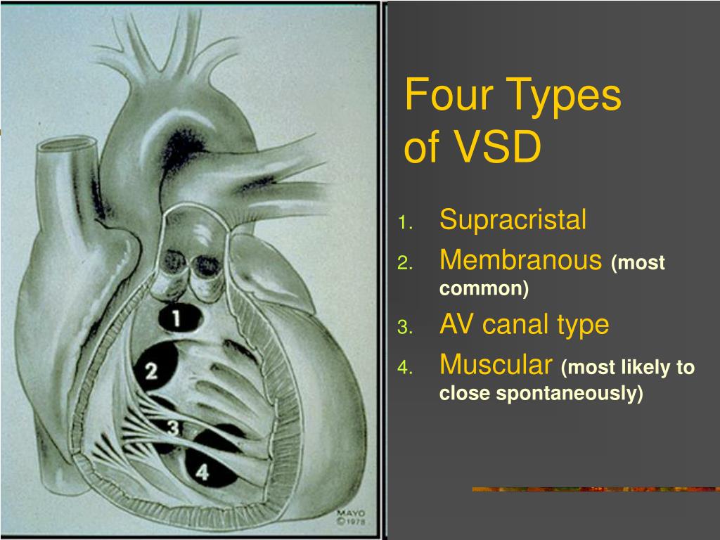 PPT - Adult Congenital Heart Disease PowerPoint Presentation, free ...