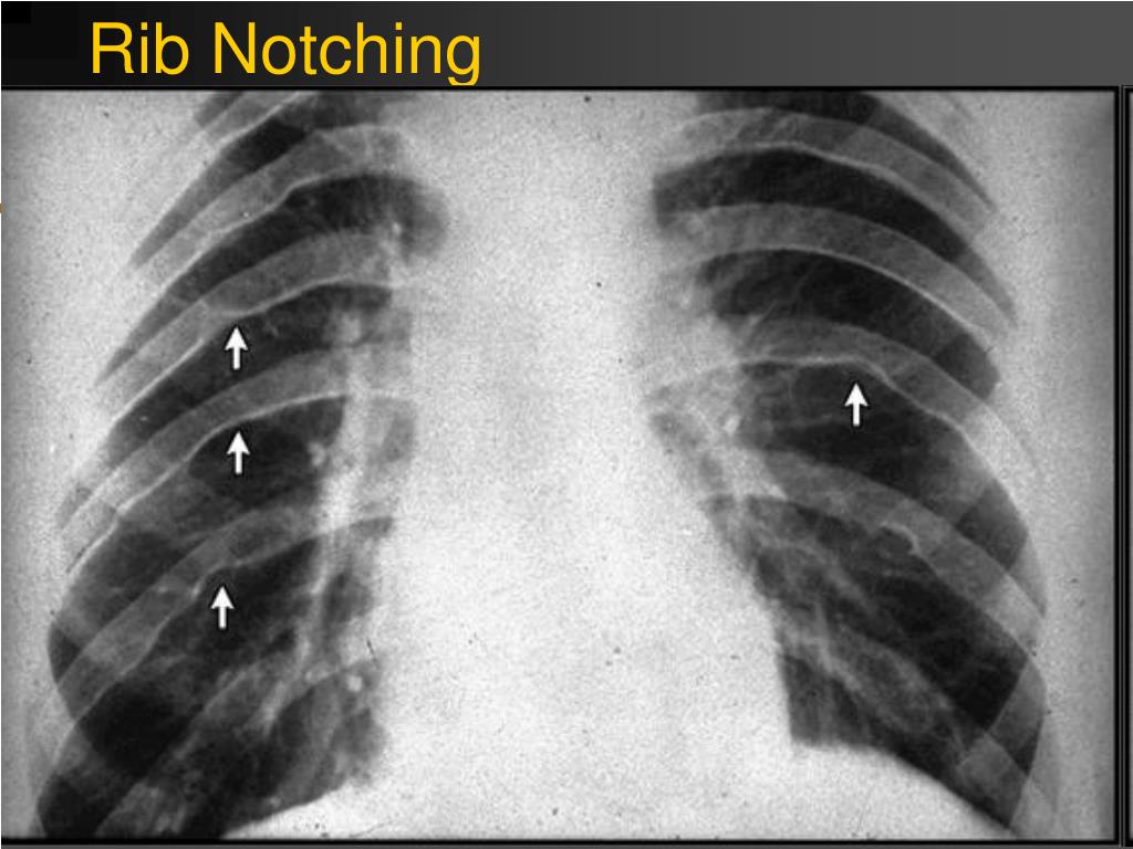 PPT - Adult Congenital Heart Disease PowerPoint Presentation, free ...