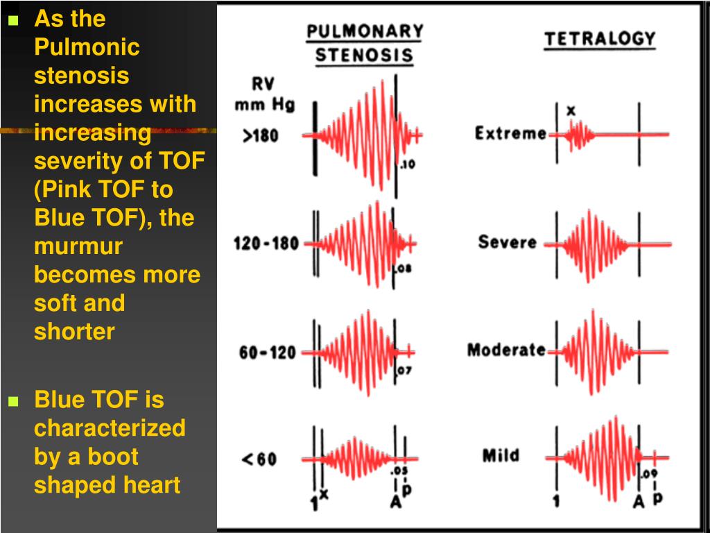 PPT - Adult Congenital Heart Disease PowerPoint Presentation, free ...