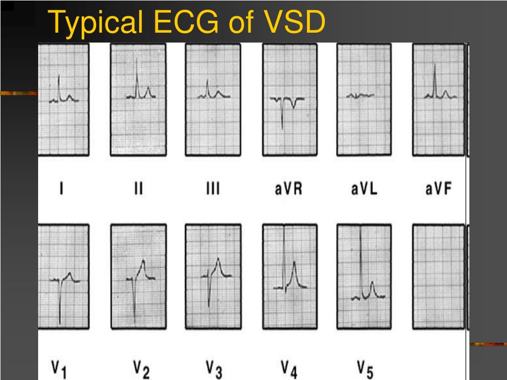 PPT - Adult Congenital Heart Disease PowerPoint Presentation, free ...