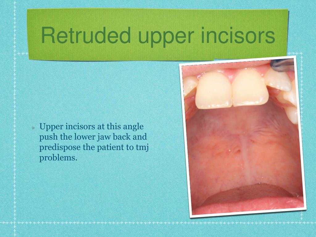 PPT - Adult Class II Div. 2 Patient of Sunpark Dental and Wayne K Smith ...