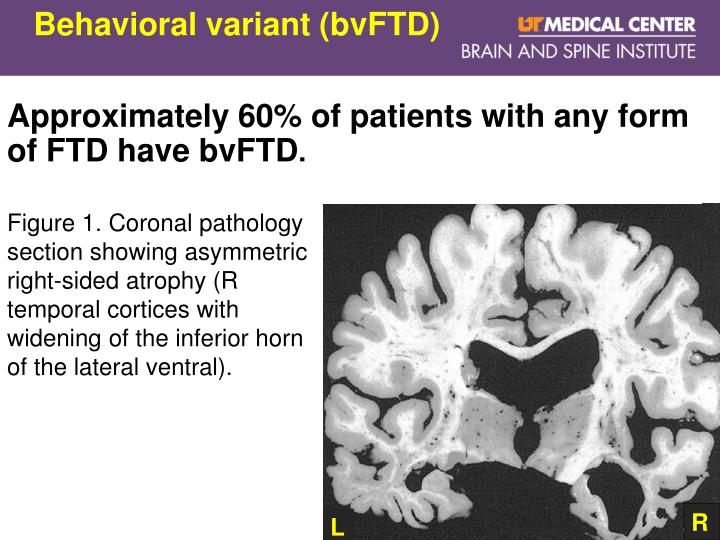 PPT - Frontotemporal Dementia (FTD) PowerPoint Presentation - ID:6392277