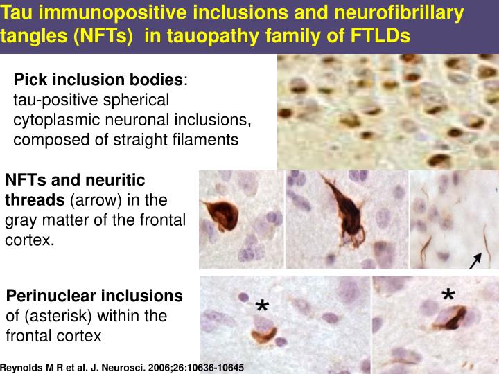 PPT - Frontotemporal Dementia (FTD) PowerPoint Presentation - ID:6392277