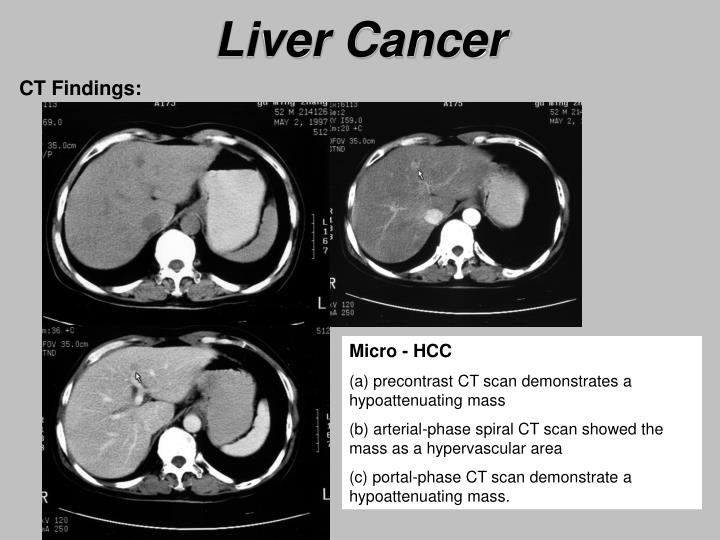 PPT - Liver Cancer PowerPoint Presentation - ID:6399378