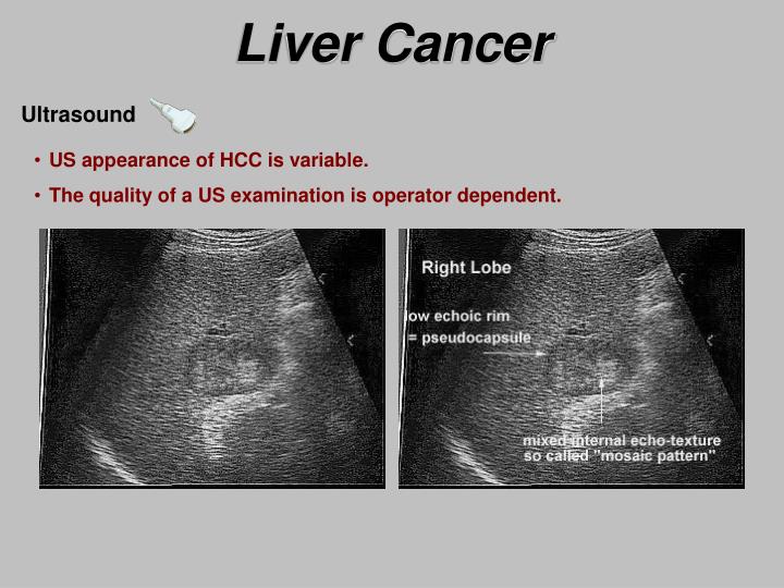 PPT - Liver Cancer PowerPoint Presentation - ID:6399378