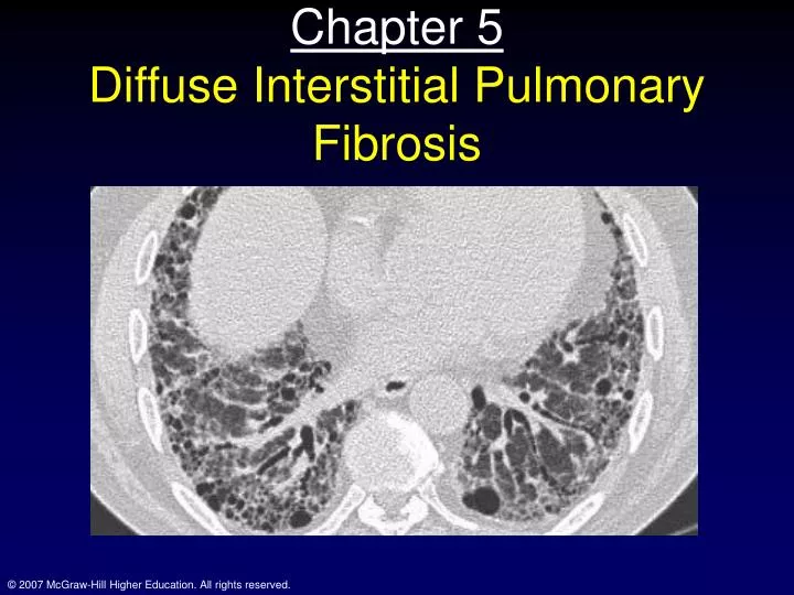 PPT - Chapter 5 Diffuse Interstitial Pulmonary Fibrosis PowerPoint ...
