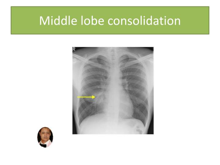 PPT - Atelectasis Lung Collapse Part-2 by Dr Bashir Ahmed Dar ...