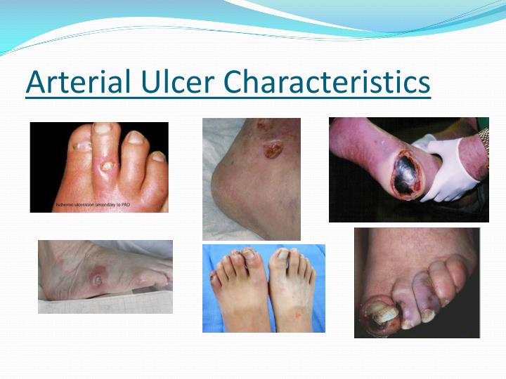 PPT - Ulcerations Due to Peripheral Vascular Disease PowerPoint ...