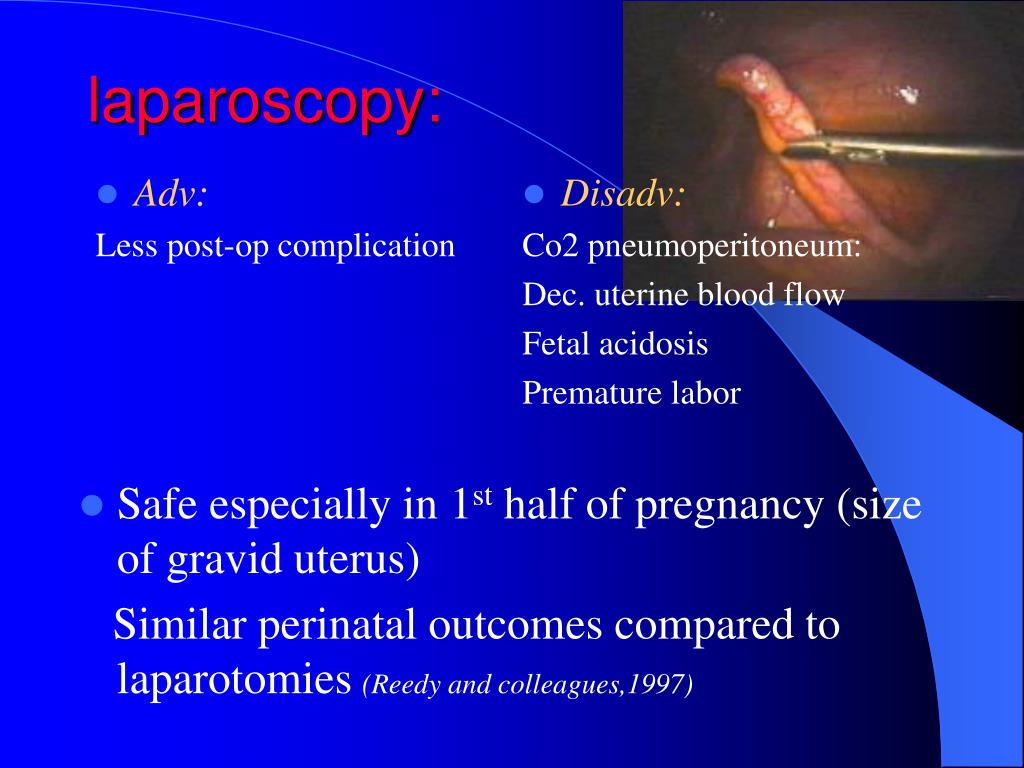 Ppt Appendicitis During Pregnancy Powerpoint Presentation Free