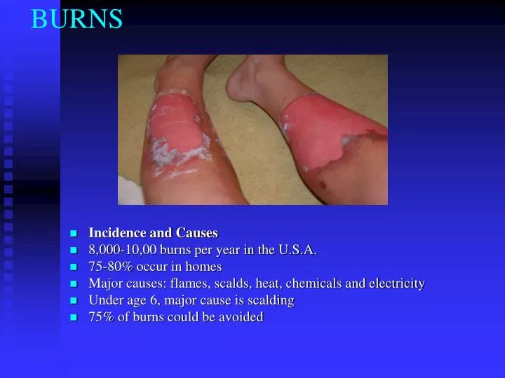 PPT - BURNS PowerPoint Presentation, free download - ID:6405329