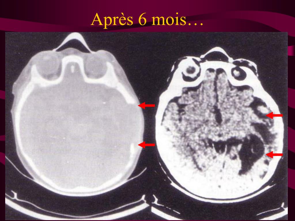 PPT - TRAUMATISMES CRANIENS & TRAUMATISMES VERTEBRAUX PowerPoint ...