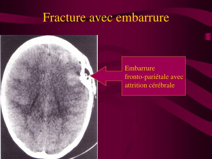 PPT - TRAUMATISMES CRANIENS & TRAUMATISMES VERTEBRAUX PowerPoint ...