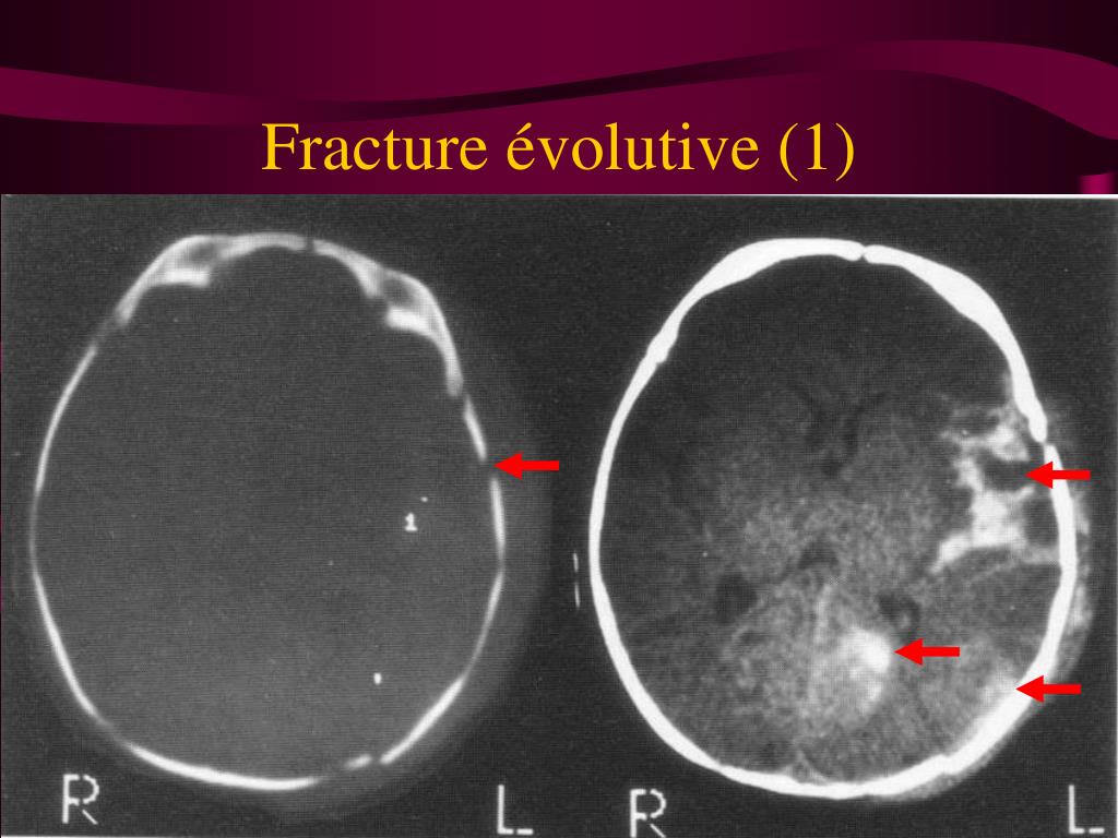 PPT - TRAUMATISMES CRANIENS & TRAUMATISMES VERTEBRAUX PowerPoint ...