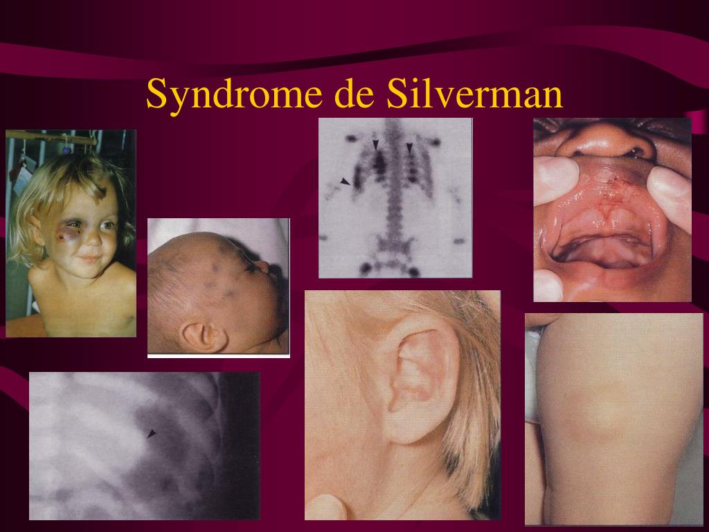 PPT - TRAUMATISMES CRANIENS & TRAUMATISMES VERTEBRAUX PowerPoint ...