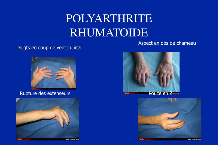PPT - Polyarthrite Rhumatoïde Olivier Brocq Service Rhumatologie ...