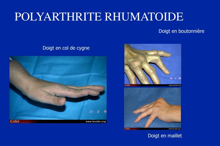 PPT - Polyarthrite Rhumatoïde Olivier Brocq Service Rhumatologie ...