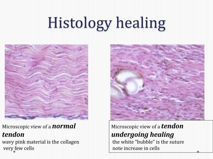PPT - Achilles Tendon Injuries PowerPoint Presentation - ID:6408022