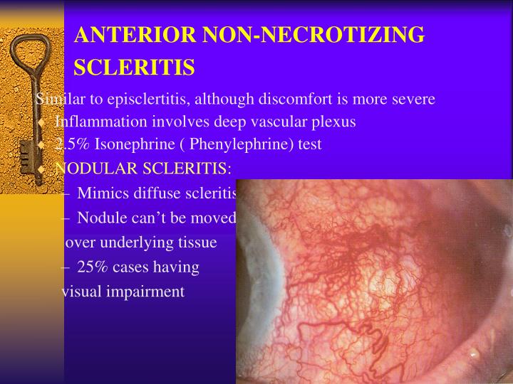 PPT - EPISCLERITIS/ SCLERITIS PowerPoint Presentation - ID:6415513